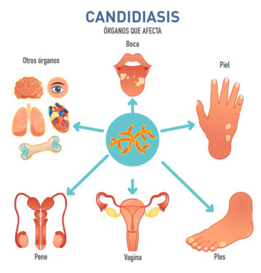 Candidiasis vaginal - Policlínico San Miguel